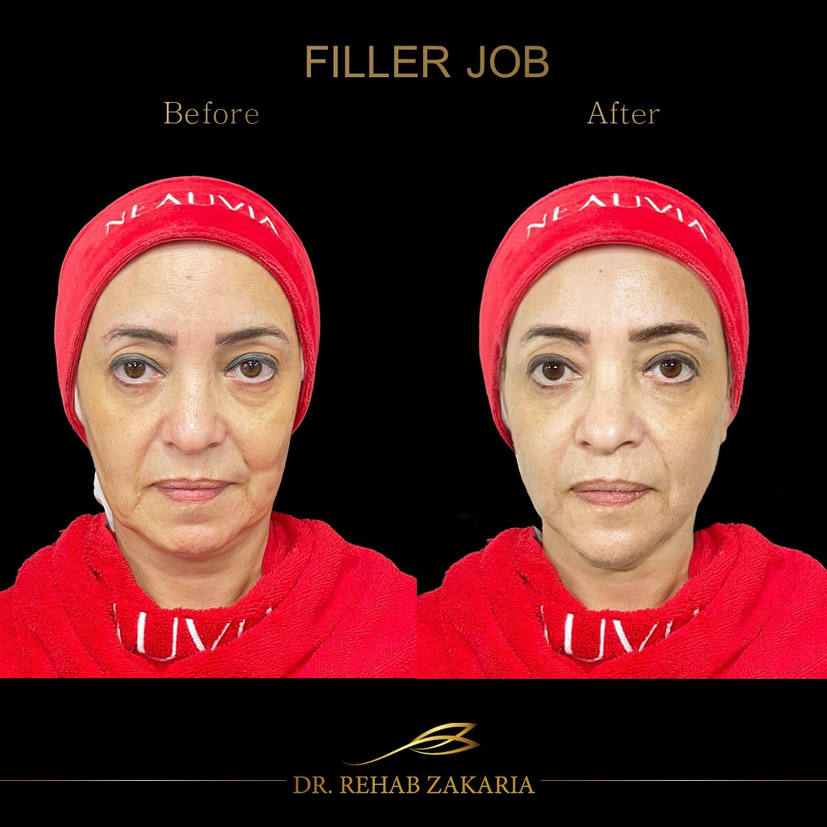 تجميل الوجه بالفيلر - دليلِك الشامل الي أنواع الفيلر