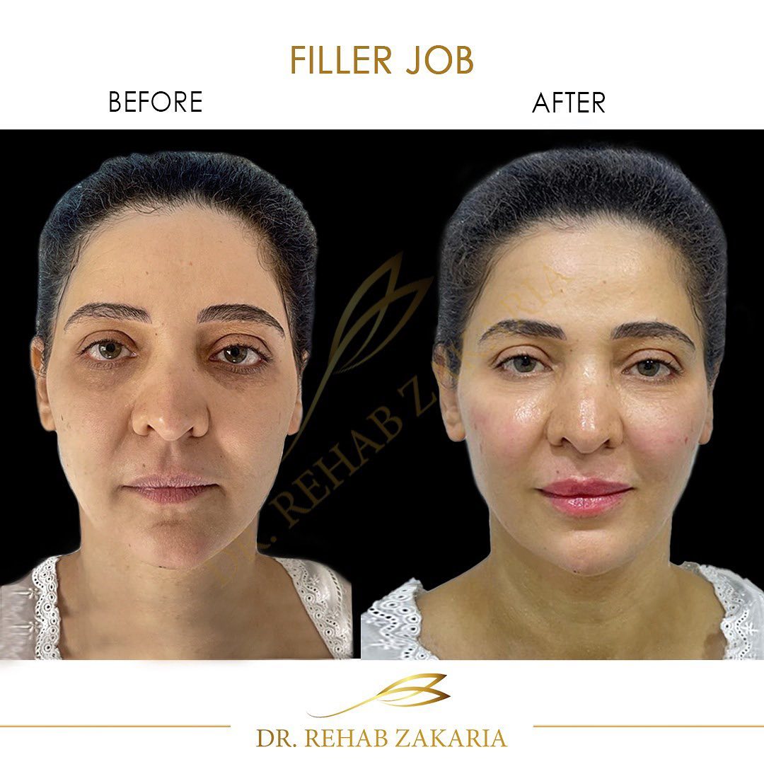 تجميل الوجه بالفيلر - دليلِك الشامل الي أنواع الفيلر