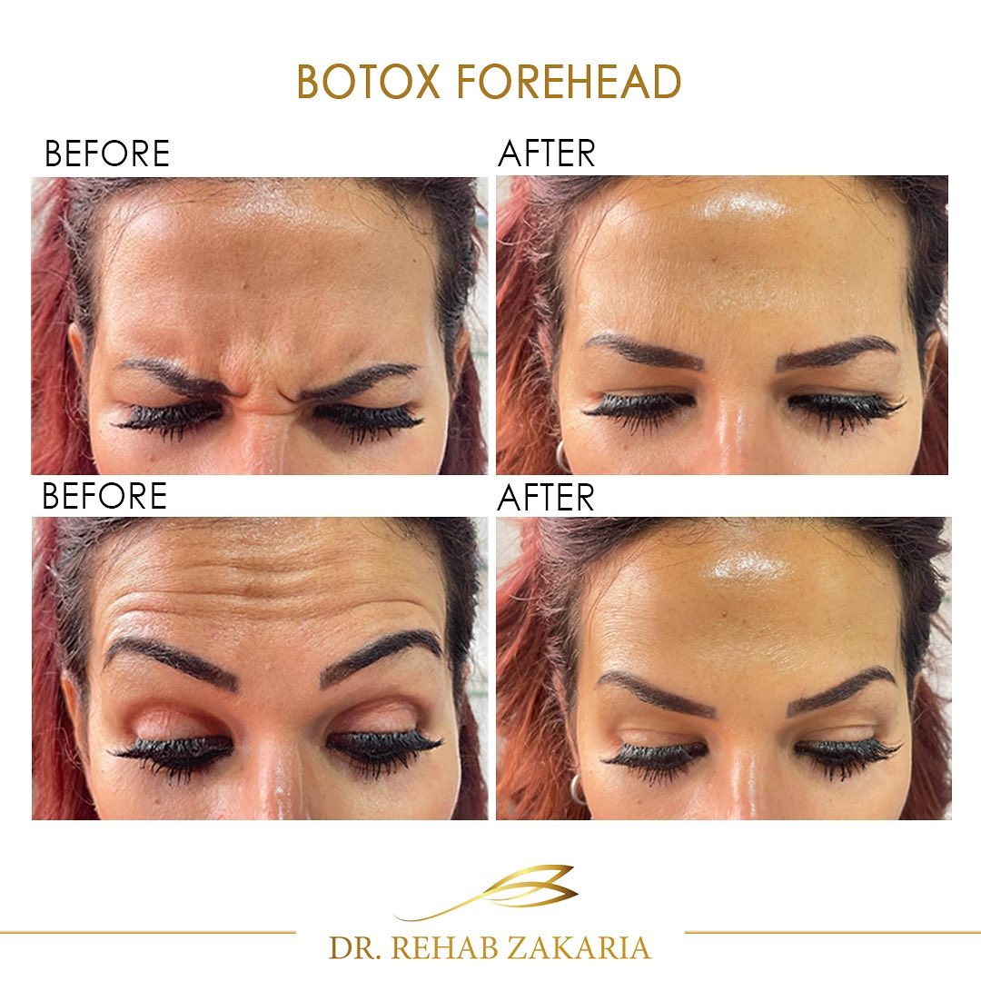Best Botox in Egypt and new cairo - Dr Rehab Zakaria